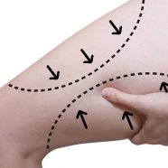 Thread Lift - Is the Lunch Time Lift Right for You? - Cost Info